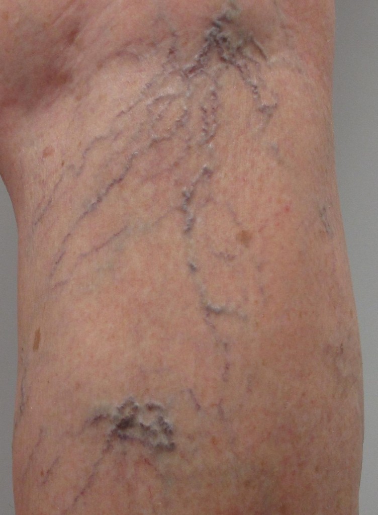 ¿Qué son las varices? | Várices - Información y tratamiento